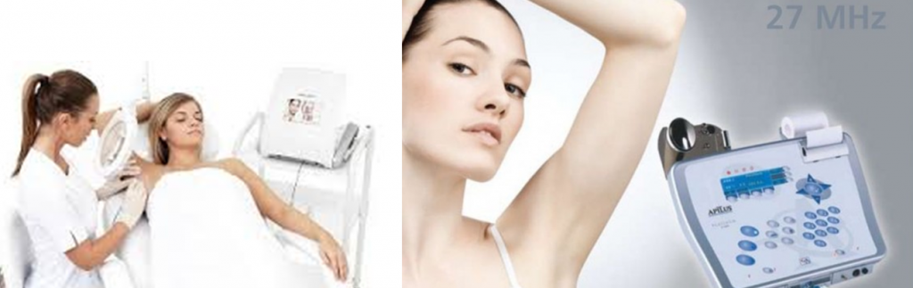 Epilation définitive